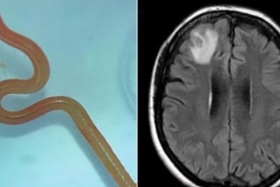 Ya Tuhan, Ada Cacing Gelang Hidup di Otak Manusia - TIMES Indonesia